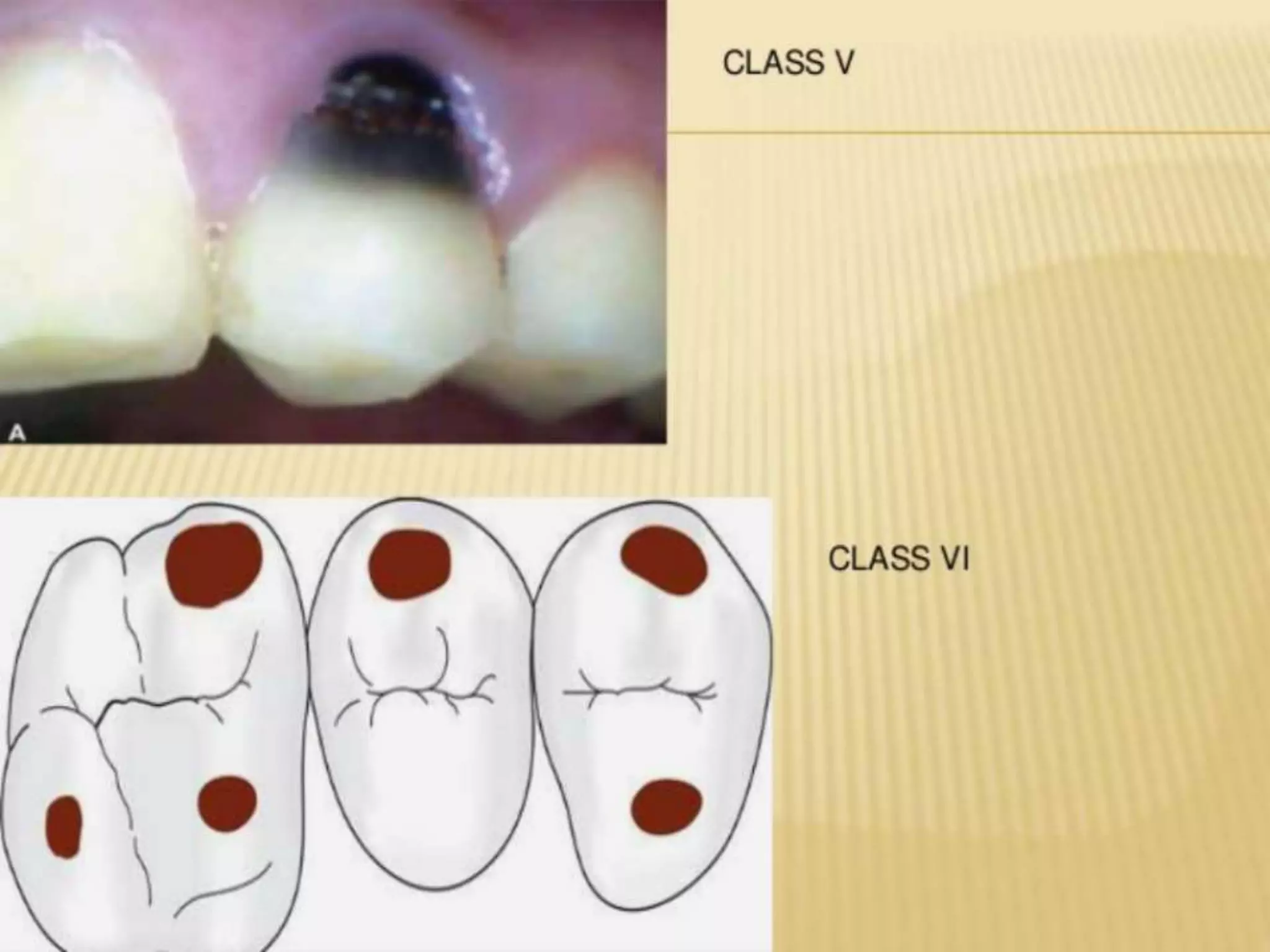 Principles of cavity preparation | PPTX