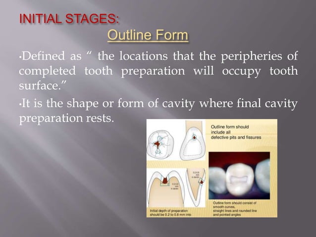 Principles of cavity preparation | PPTX | Dental Health | Diseases and Conditions