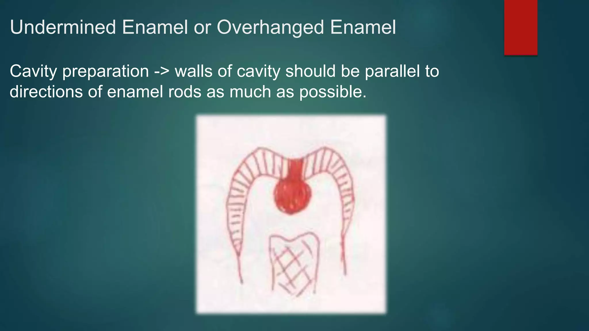 Principles_of_cavity_preparation_accordi.ppsx