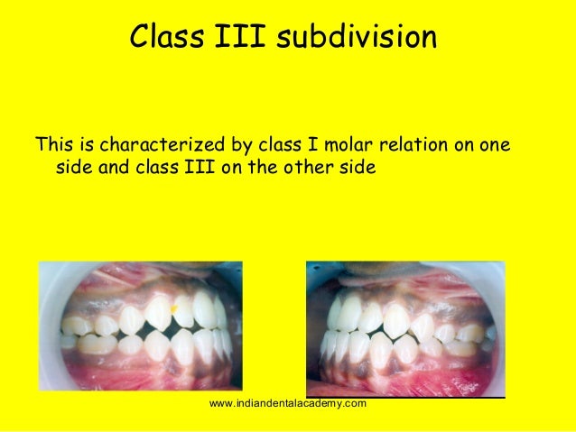 Principles of class iii treatment reformated /certified fixed orthodo…
