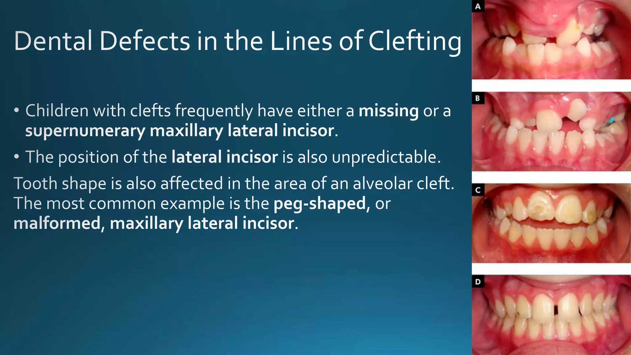 Principles of cleft lip and palate formation | PPTX