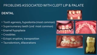 Principles of cleft lip and palate formation | PPTX