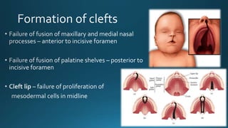 Principles of cleft lip and palate formation | PPTX
