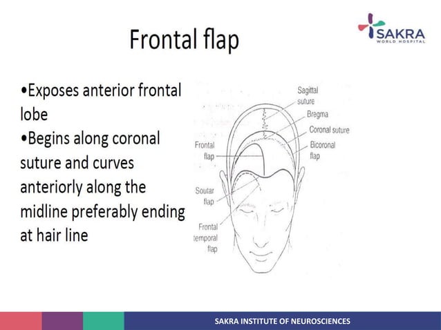 Principles of craniotomy flaps | PPTX