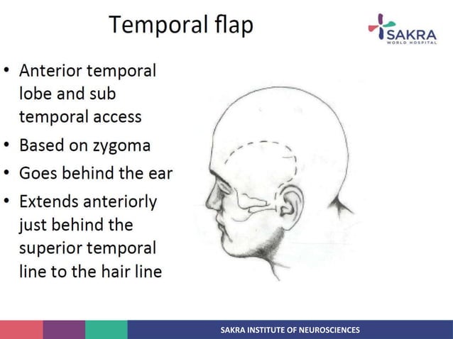 Principles of craniotomy flaps | PPTX