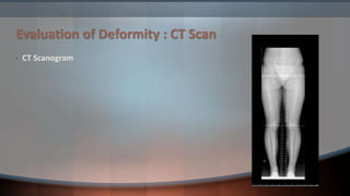 Principles of deformity correction | PPTX