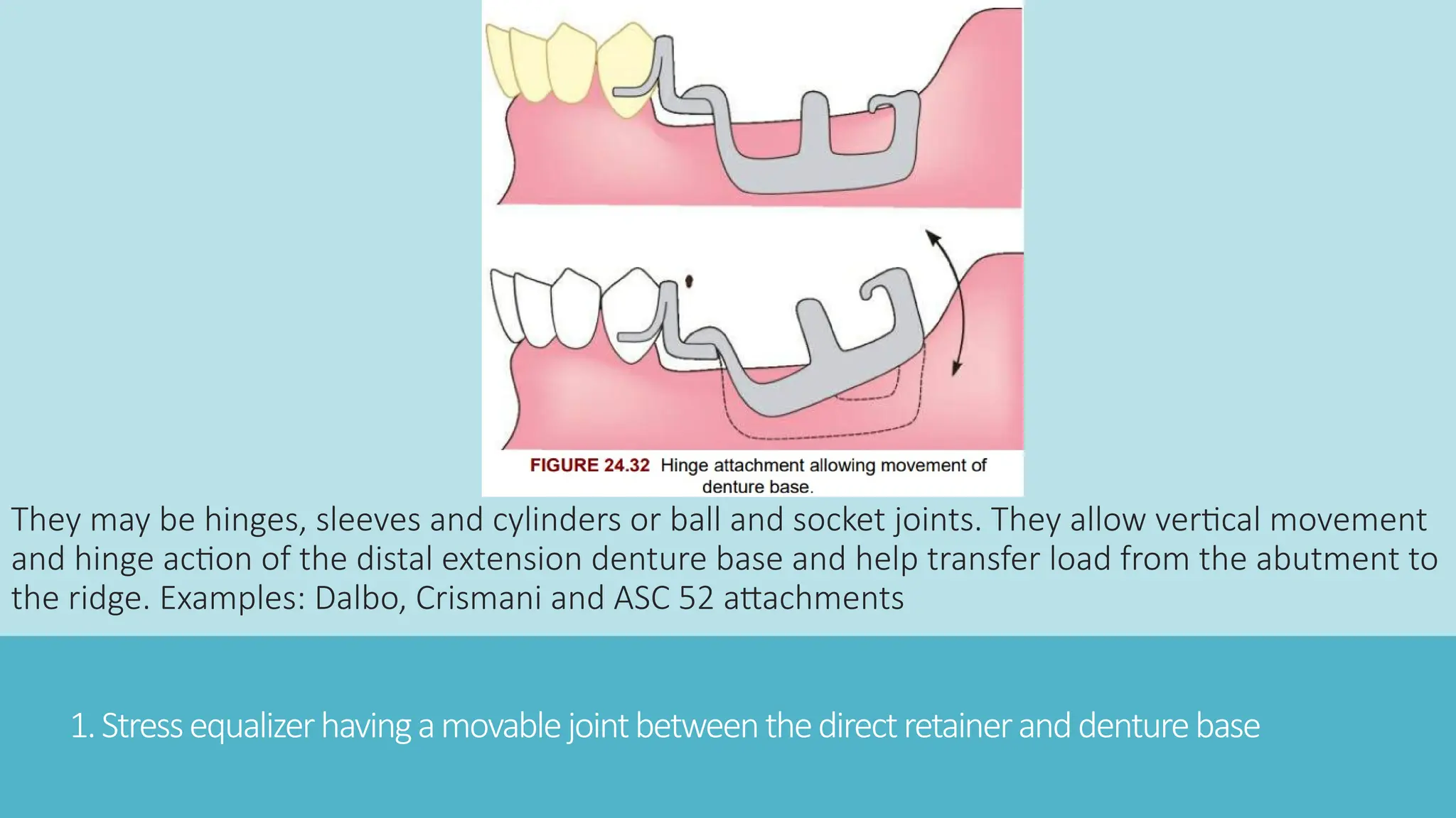 PRINCIPLES OF DESIGN IN RPD DESIGING UG LEVEL | PPTX