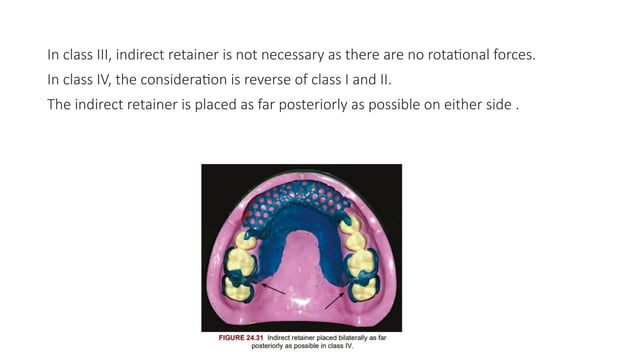 PRINCIPLES OF DESIGN IN RPD DESIGING UG LEVEL | PPTX