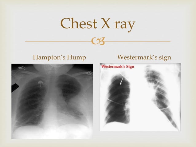 Principles of diagnosis & management of acute pulmonary | PPTX | Heart ...
