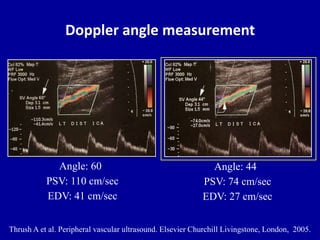 Principles of Doppler ultrasound | PPTX