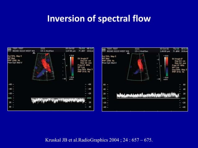 Principles of Doppler ultrasound | PPTX