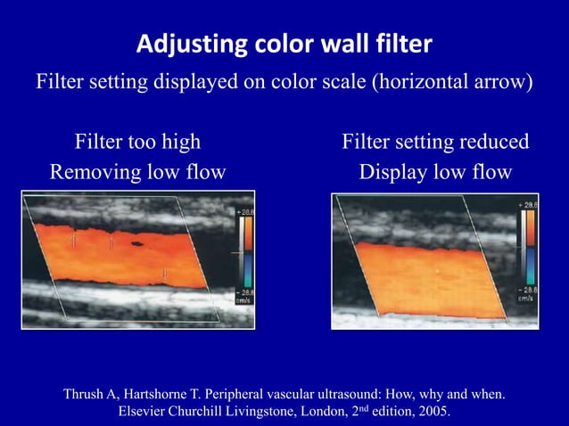 Principles of Doppler ultrasound | PPTX