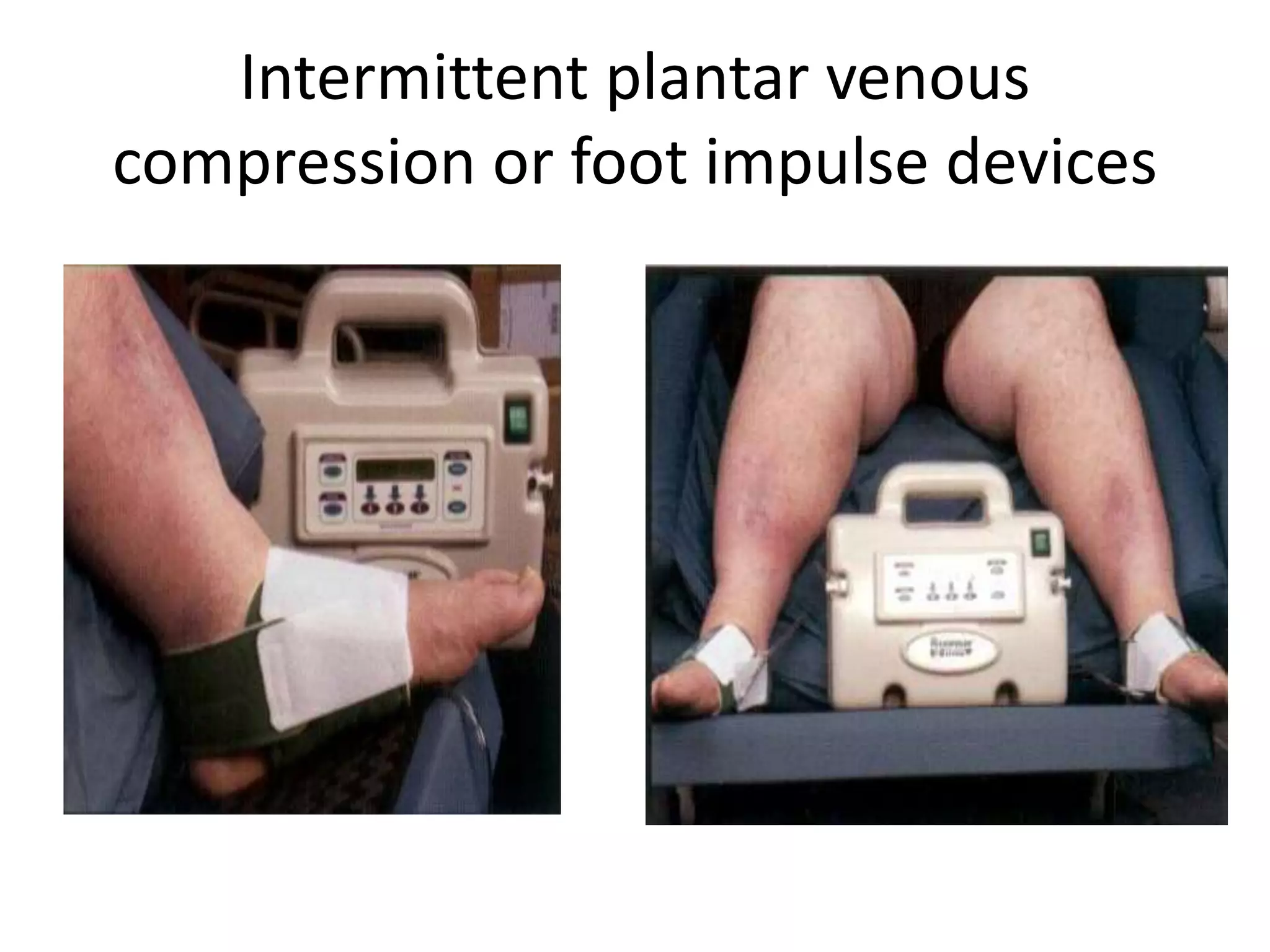 Principles of dvt prophylaxis | PPTX