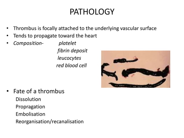 Principles of dvt prophylaxis | PPTX | Blood Disorders | Diseases and ...