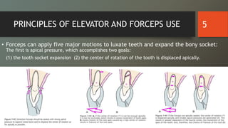 Principles of elevator and forceps use (Dentistry) | PPTX