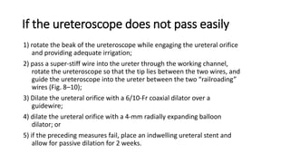 Principles of Endourology | PPTX