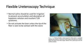 Principles of Endourology | PPTX