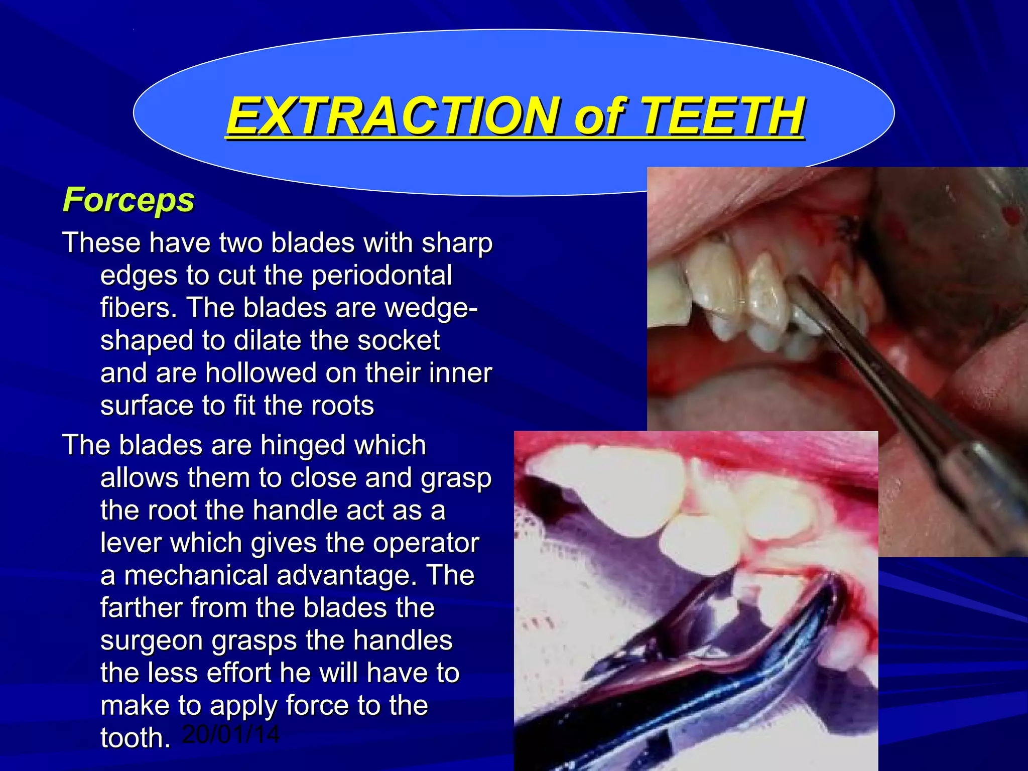 Principles of Exodontia | PPT