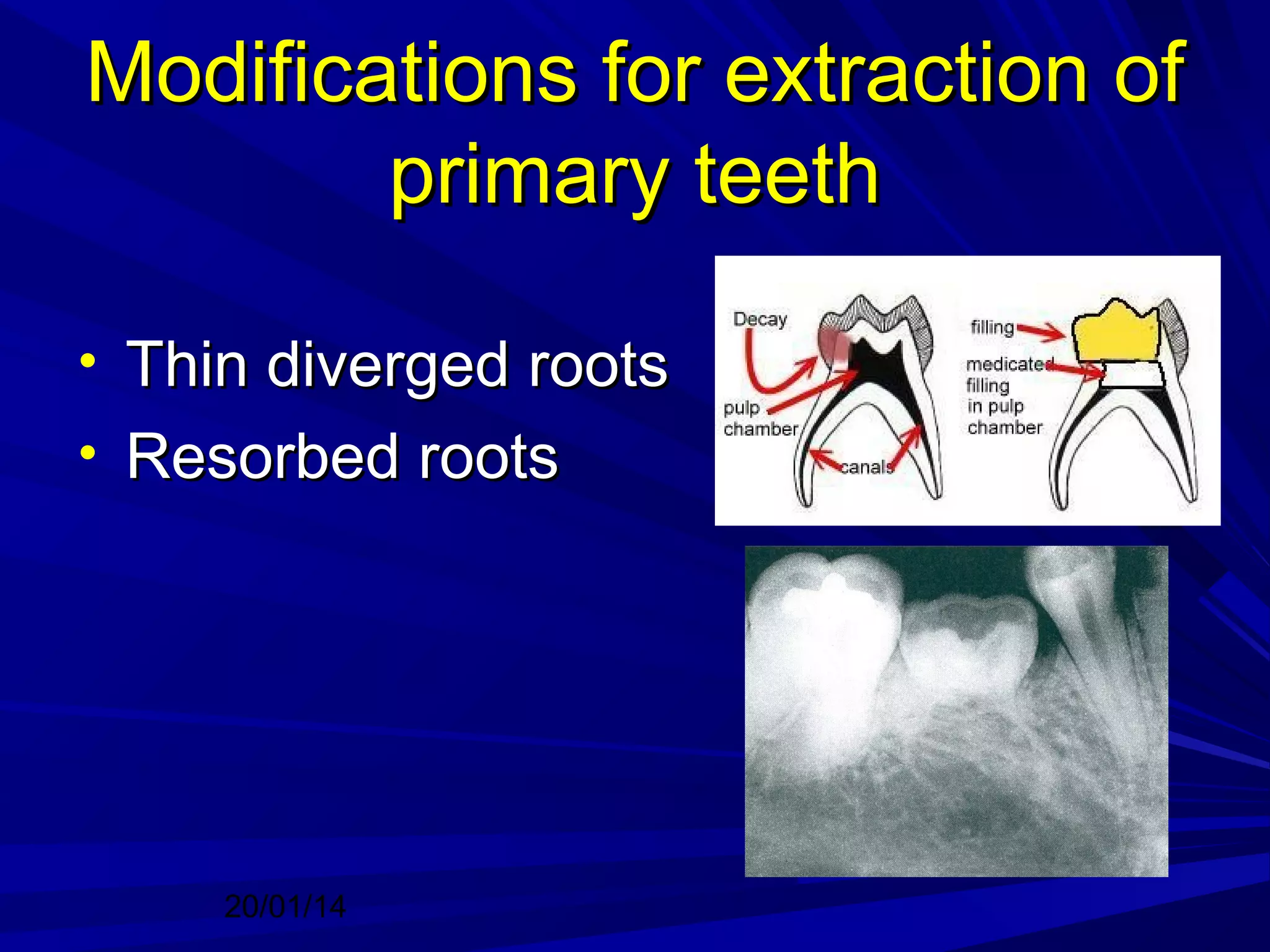 Principles of Exodontia | PPT