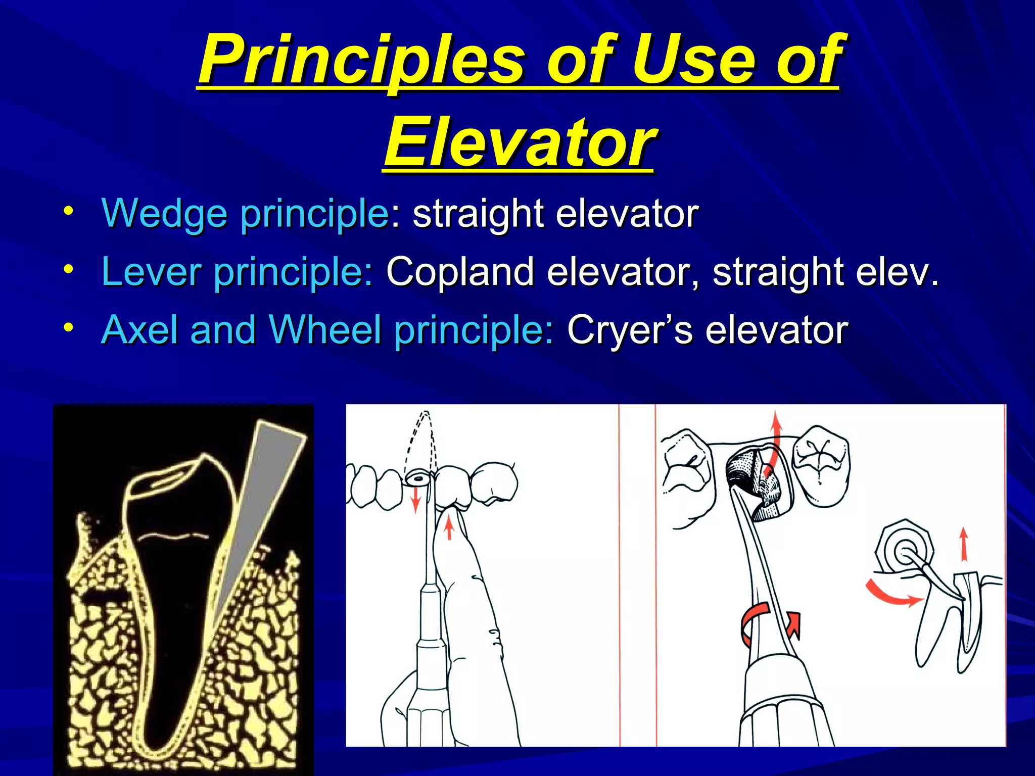 Principles of Exodontia | PPT