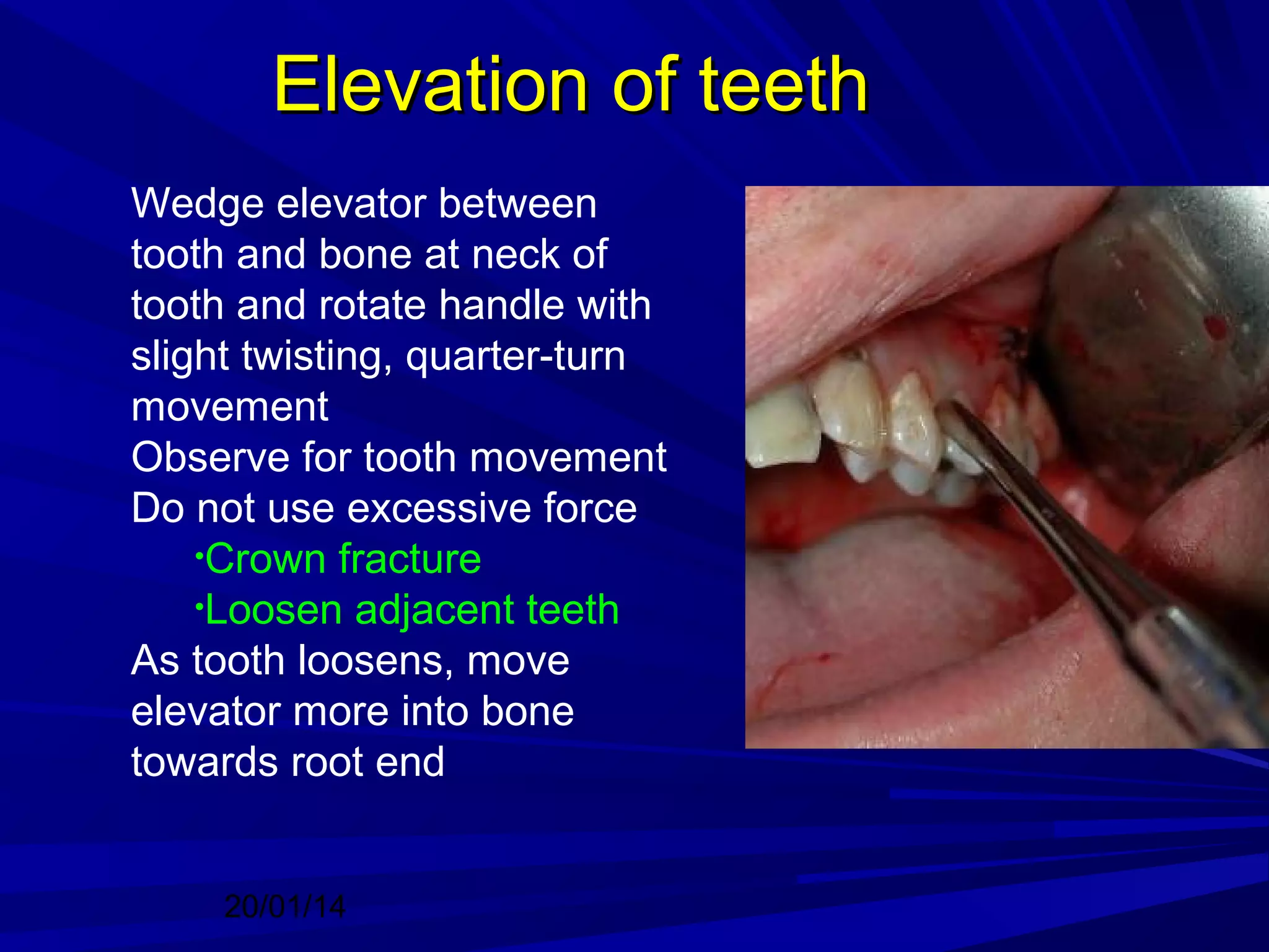 Principles of Exodontia | PPT