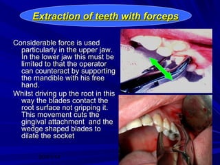 Principles of Exodontia | PPT