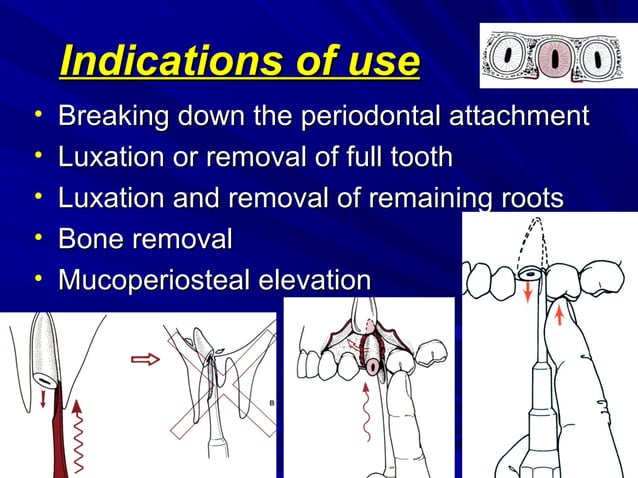 Principles of Exodontia | PPT | Oral care | Personal Care