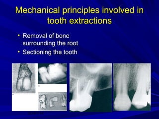 Principles of Exodontia | PPT