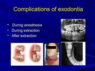Principles of Exodontia | PPT