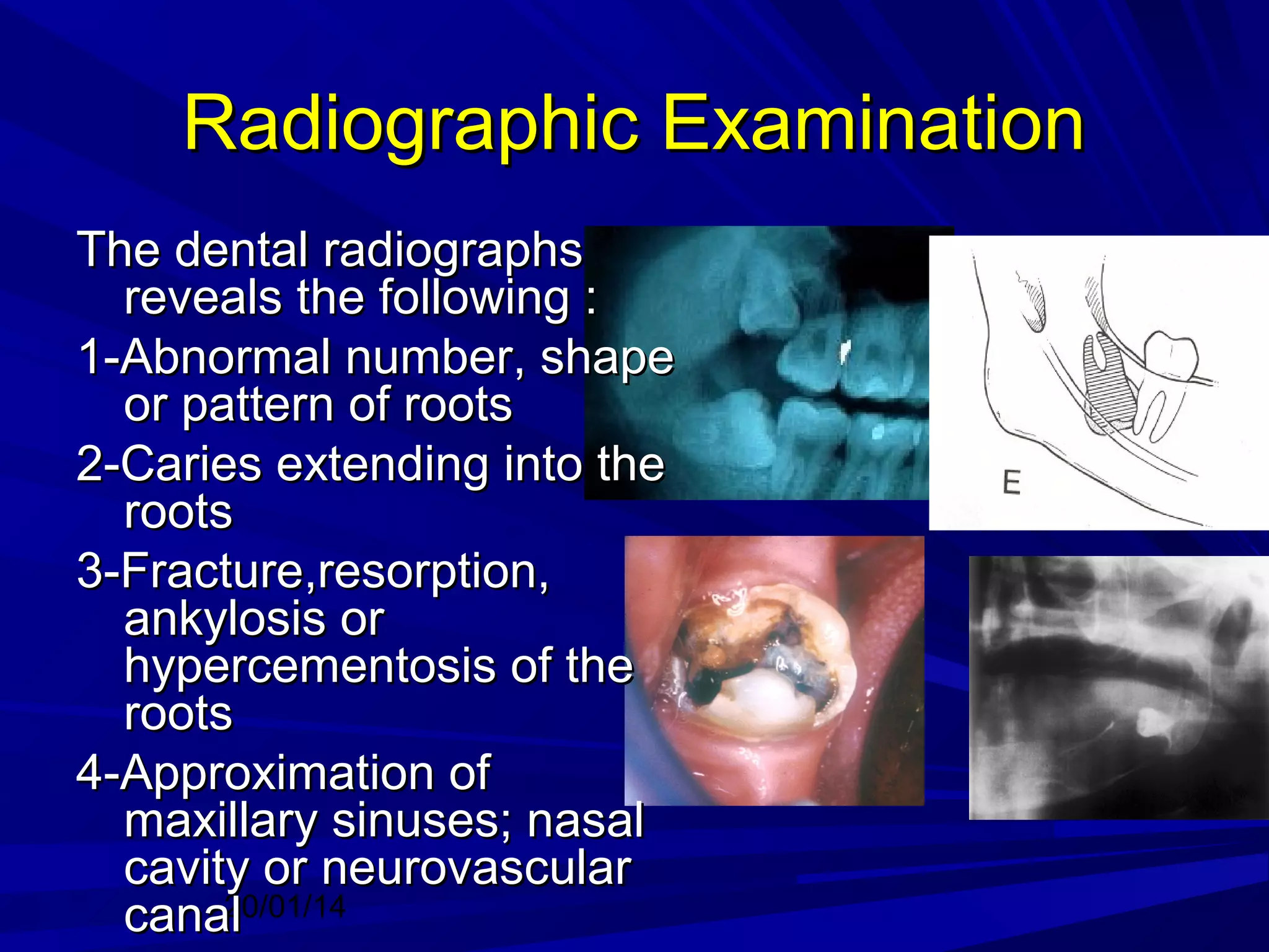 Principles of Exodontia | PPT