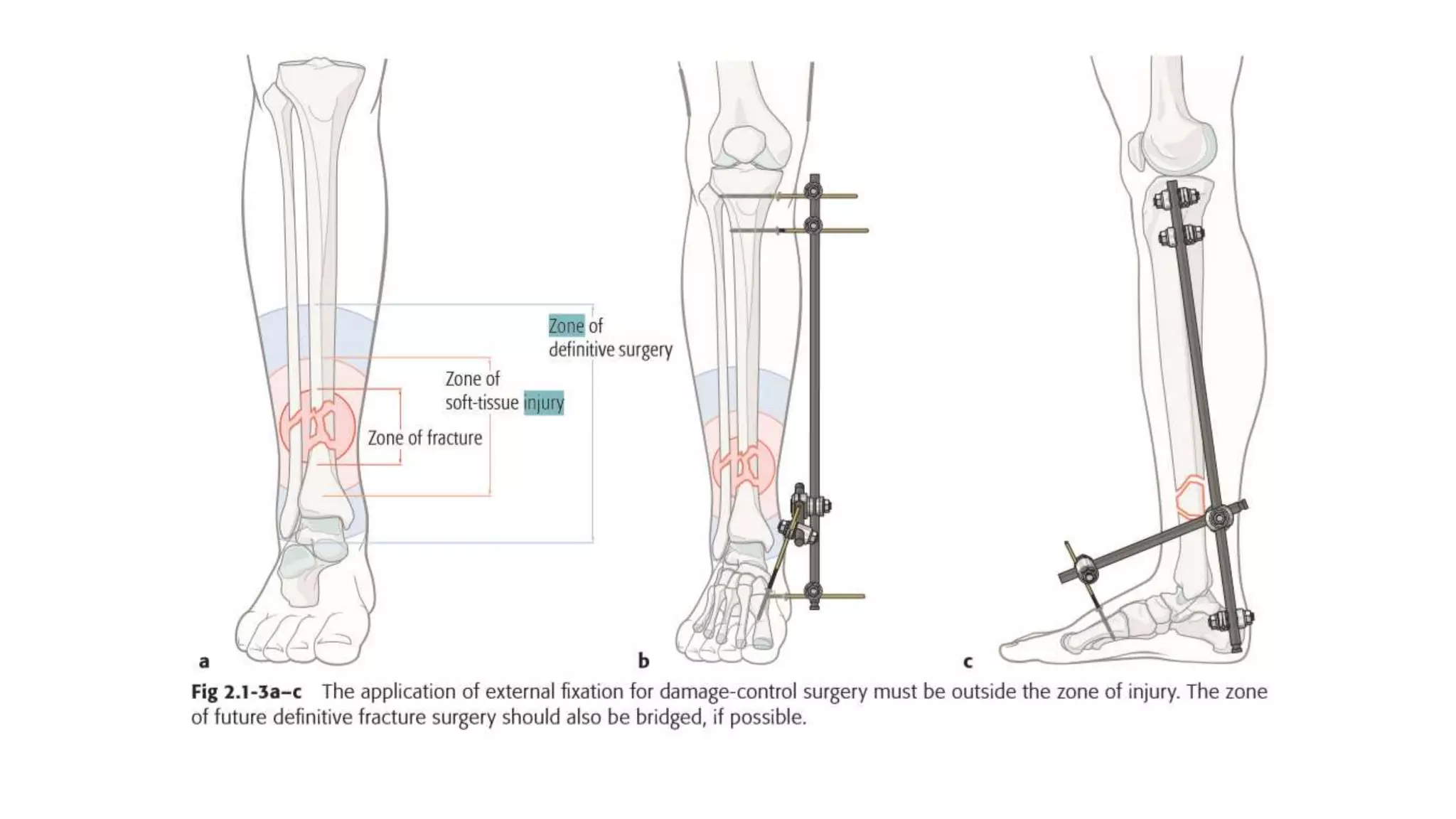 Principles of external fixation | PPTX
