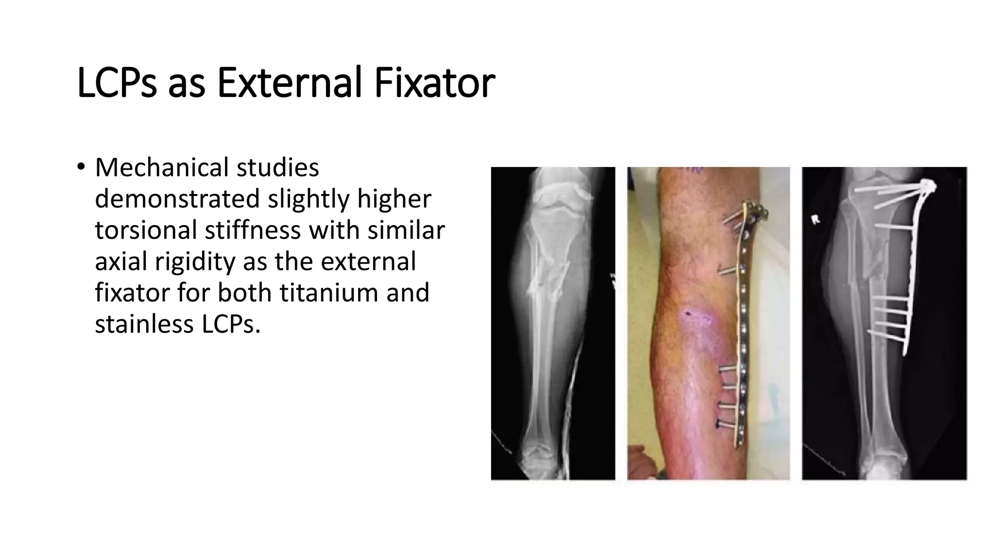 Principles of external fixation | PPTX