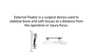 Principles of external fixation | PPTX