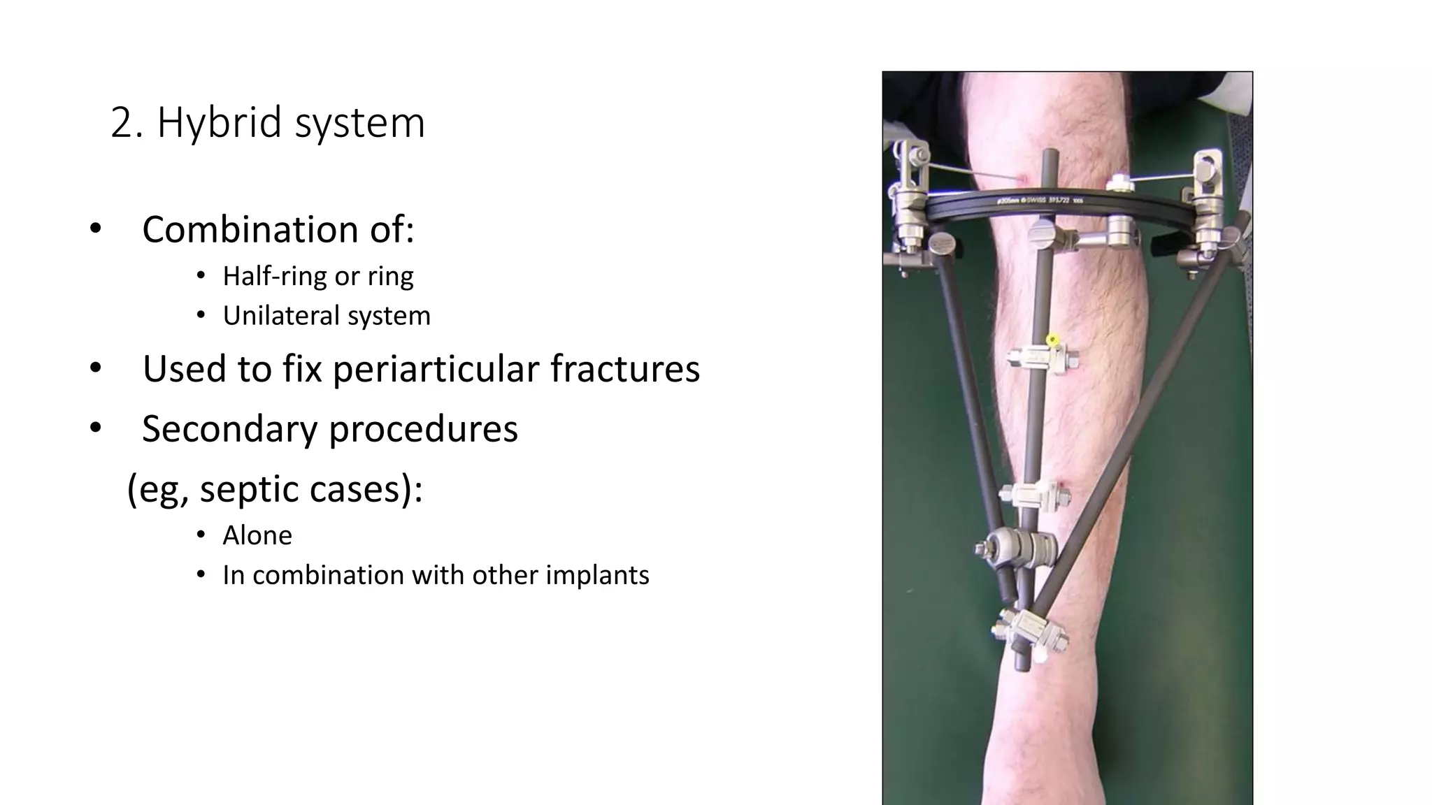 Principles of external fixation.pptx