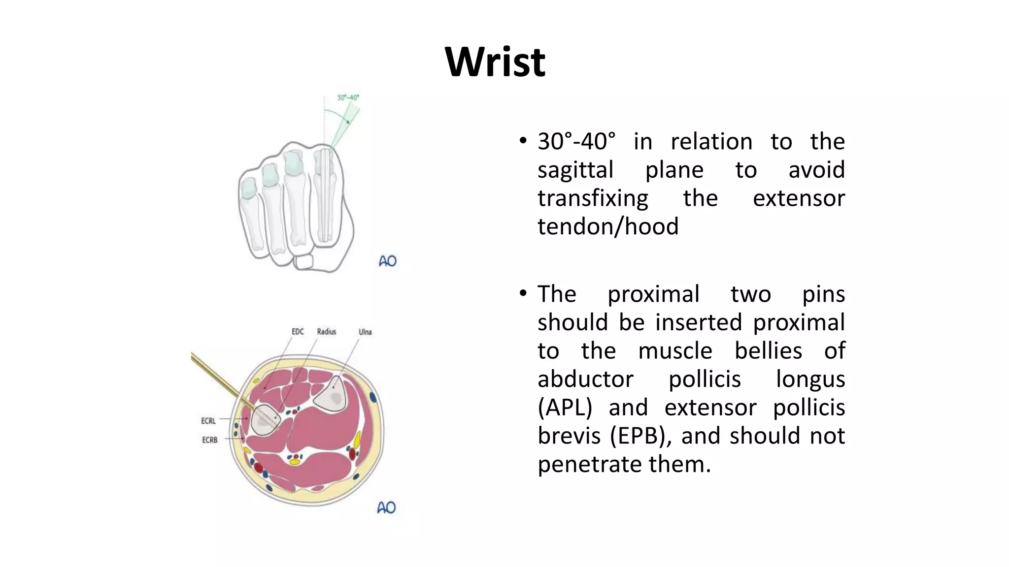 Principles of external fixation.pptx