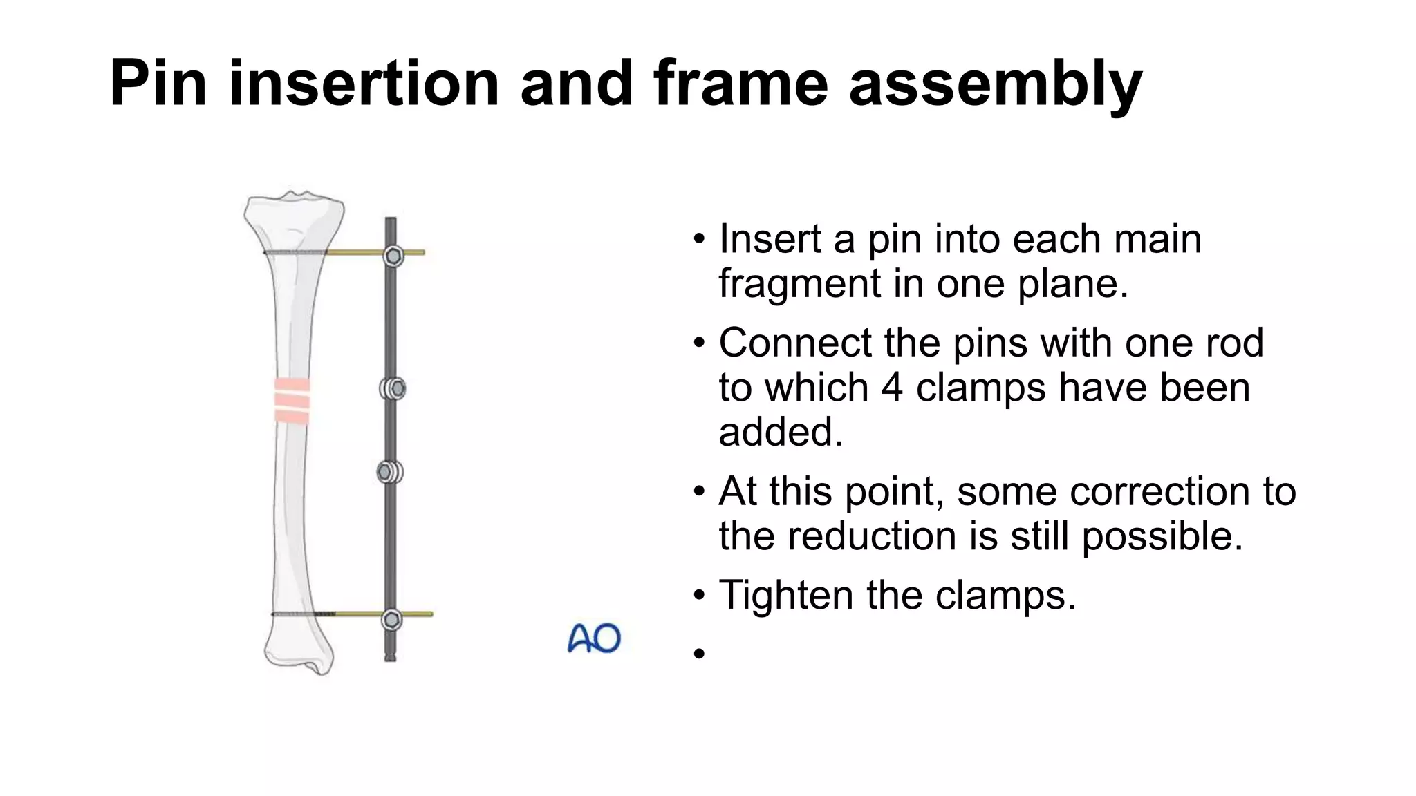 Principles of external fixation.pptx