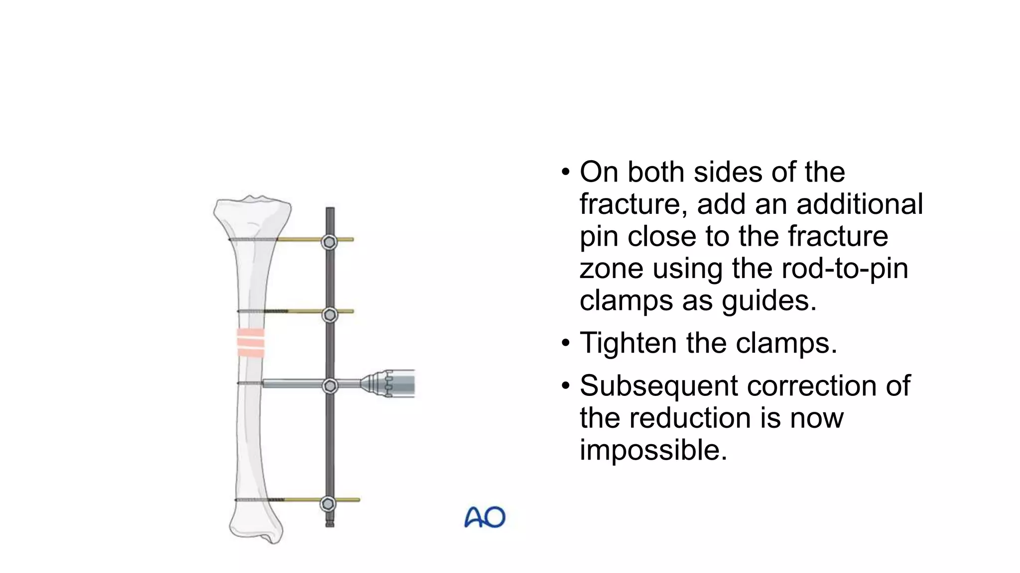 Principles of external fixation.pptx
