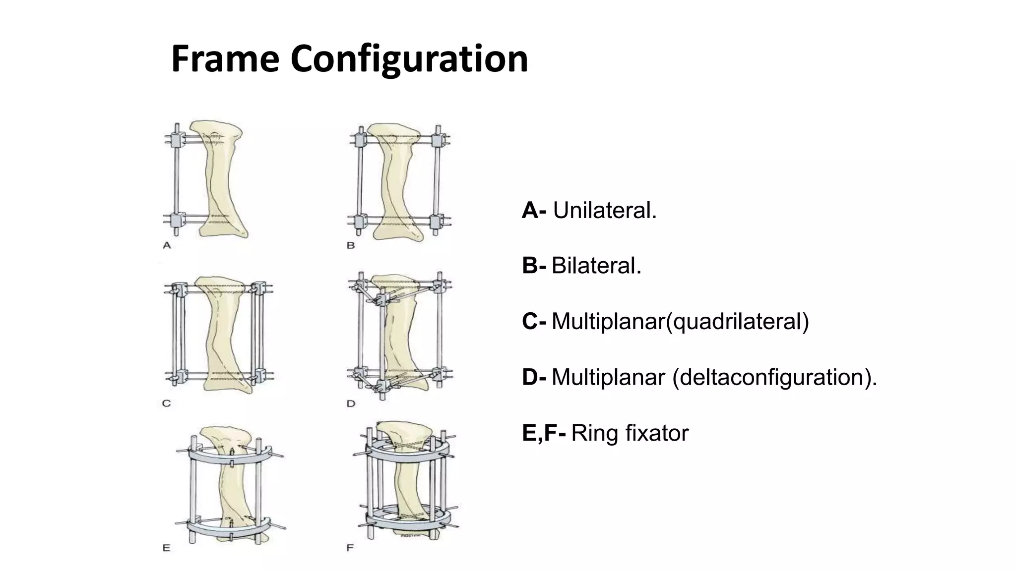 Principles of external fixation.pptx