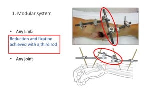 Principles of external fixation.pptx