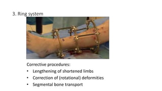 Principles of external fixation.pptx