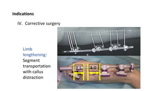 Principles of external fixation.pptx