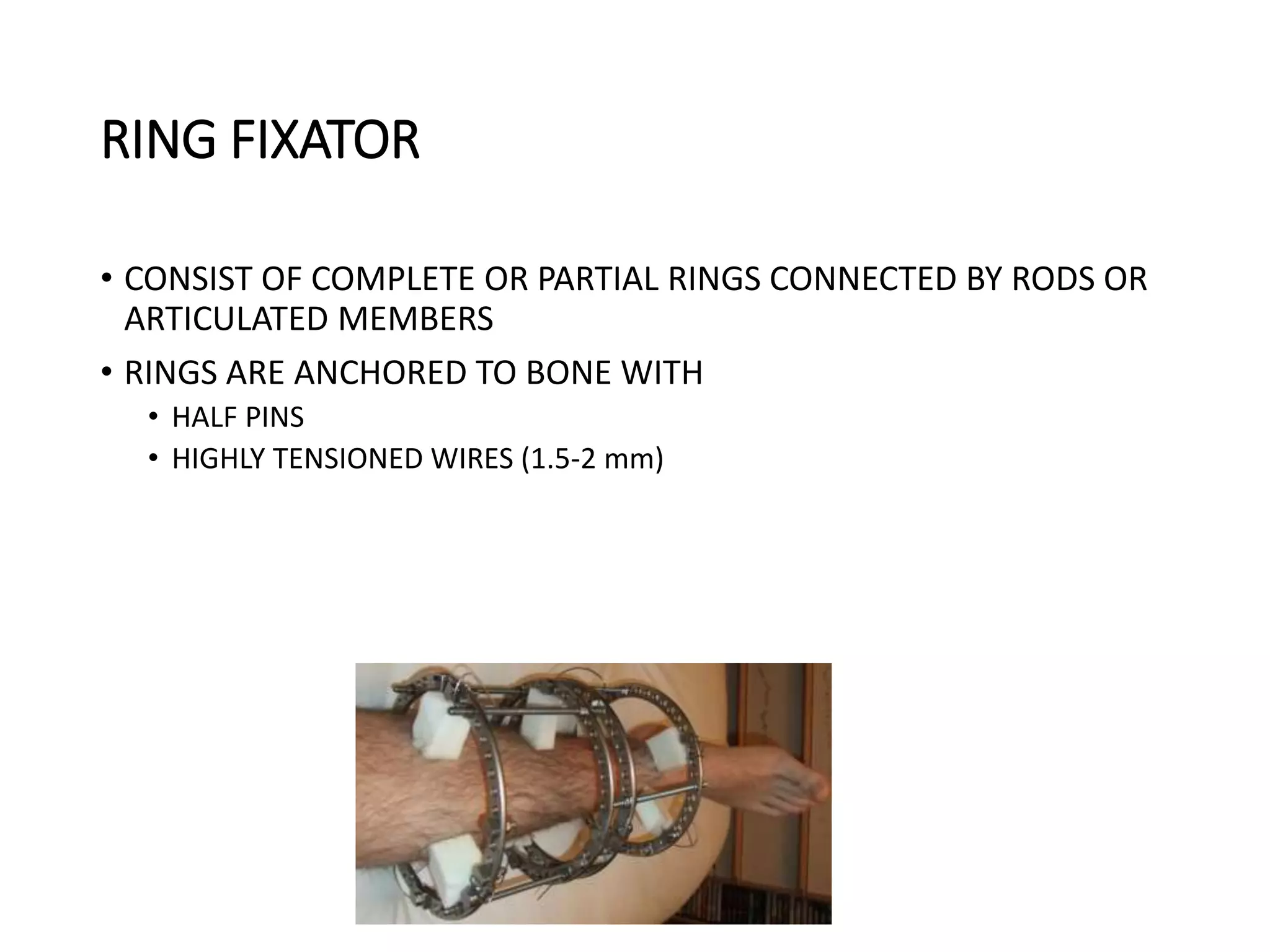 Principles of external fixation | PPTX