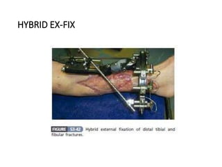 Principles of external fixation | PPTX