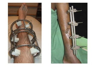 Principles of external fixation | PPTX