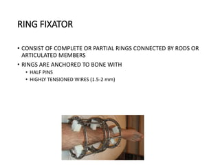 Principles of external fixation | PPTX