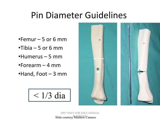 Principles of external fixator | PPT | First Aid | Injuries