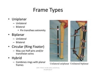Principles of external fixator | PPT