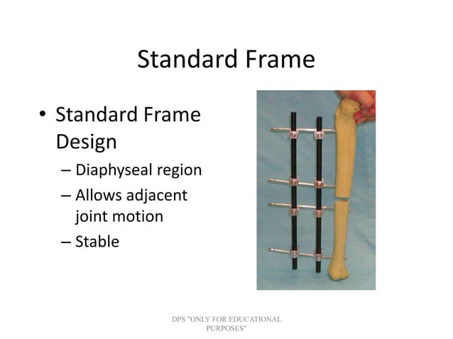 Principles of external fixator | PPT | First Aid | Injuries