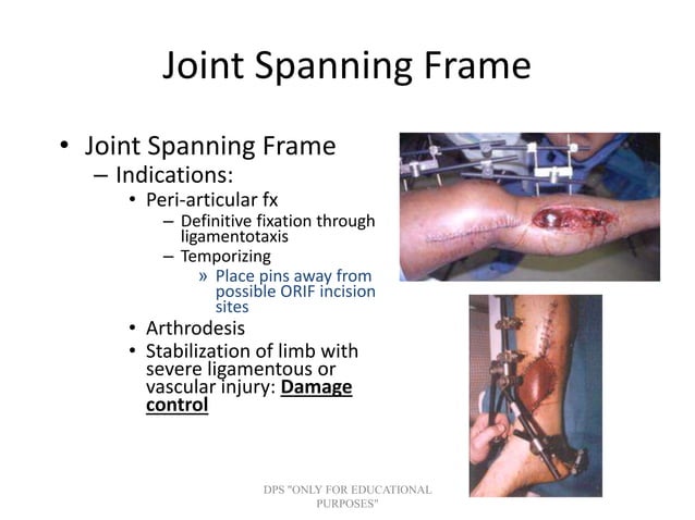 Principles of external fixator | PPT | First Aid | Injuries