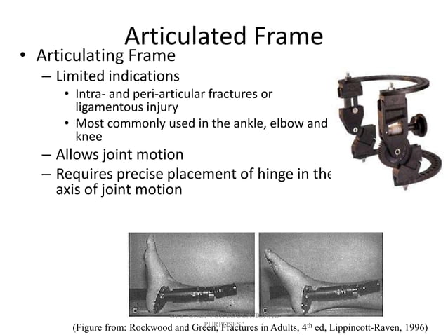 Principles of external fixator | PPT | First Aid | Injuries